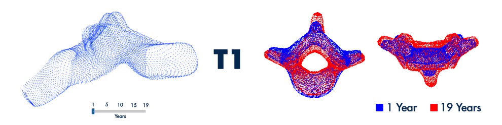 Pediatric Spine and Rib Cage Deformities | Orthopedic Biomechanics ...