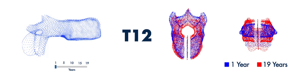 Pediatric Spine and Rib Cage Deformities | Orthopedic Biomechanics ...