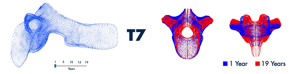 Pediatric Spine and Rib Cage Deformities | Orthopedic Biomechanics ...
